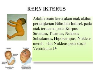 Ppt hiperbilirubin | PPTX