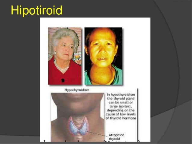 Ppt hipotiroid dan hipertiroid