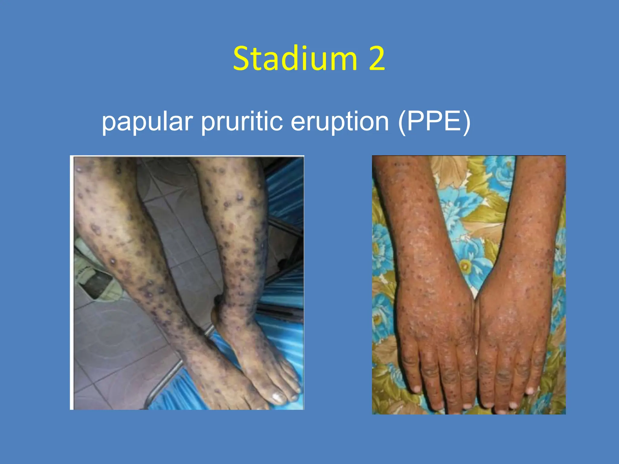 Materi mengenai Penyakit kULIT HIV DAN AIDS | PPTX