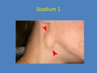 Materi mengenai Penyakit kULIT HIV DAN AIDS | PPTX