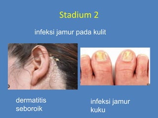 Materi mengenai Penyakit kULIT HIV DAN AIDS | PPTX
