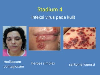 Materi mengenai Penyakit kULIT HIV DAN AIDS | PPTX