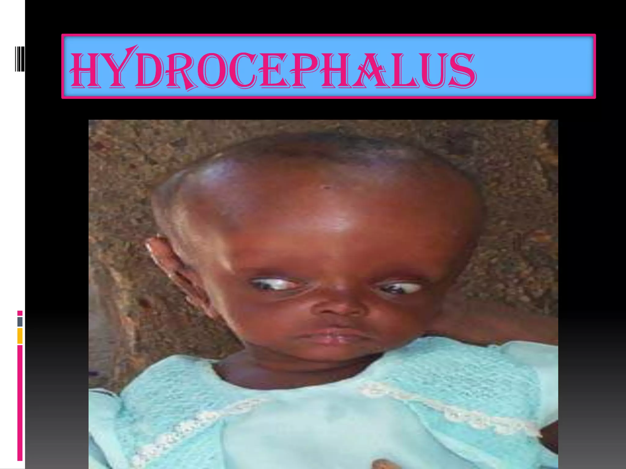 hydrocephalus | PPTX