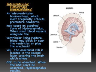 hydrocephalus | PPTX
