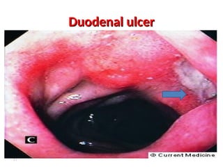 pptic ulcer pathalogy medical student.ppt