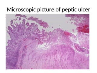 pptic ulcer pathalogy medical student.ppt