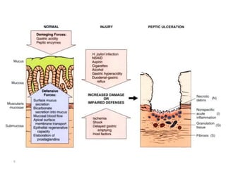 pptic ulcer pathalogy medical student.ppt