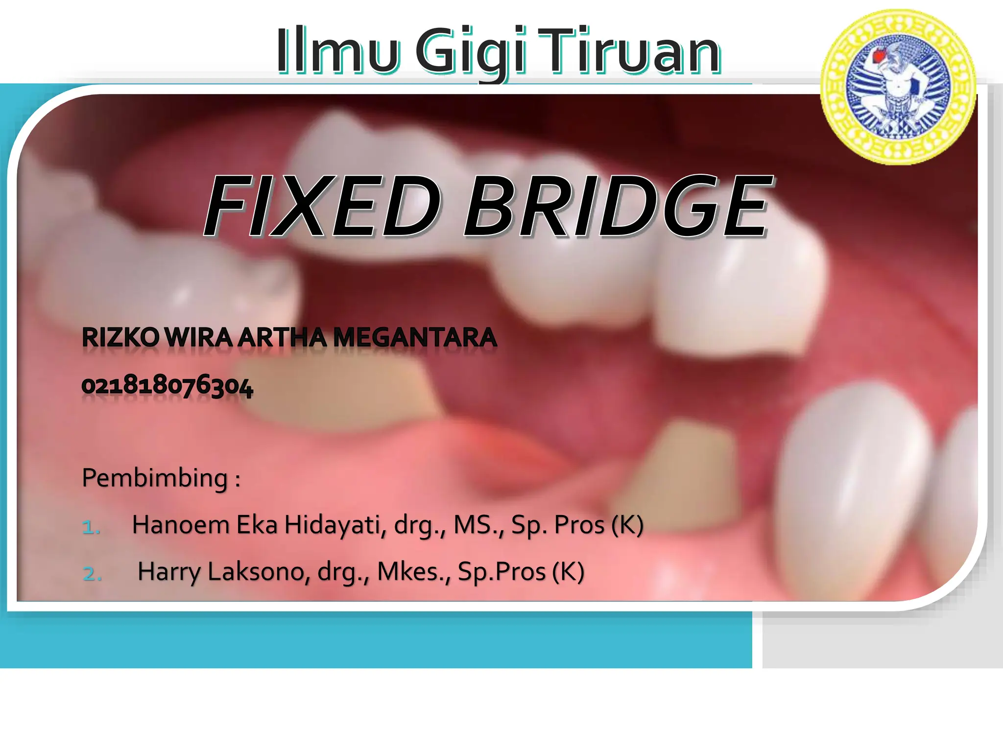 ilmu gigi tiruan fixed bridge / gigi tiruan jembatan | PPTX