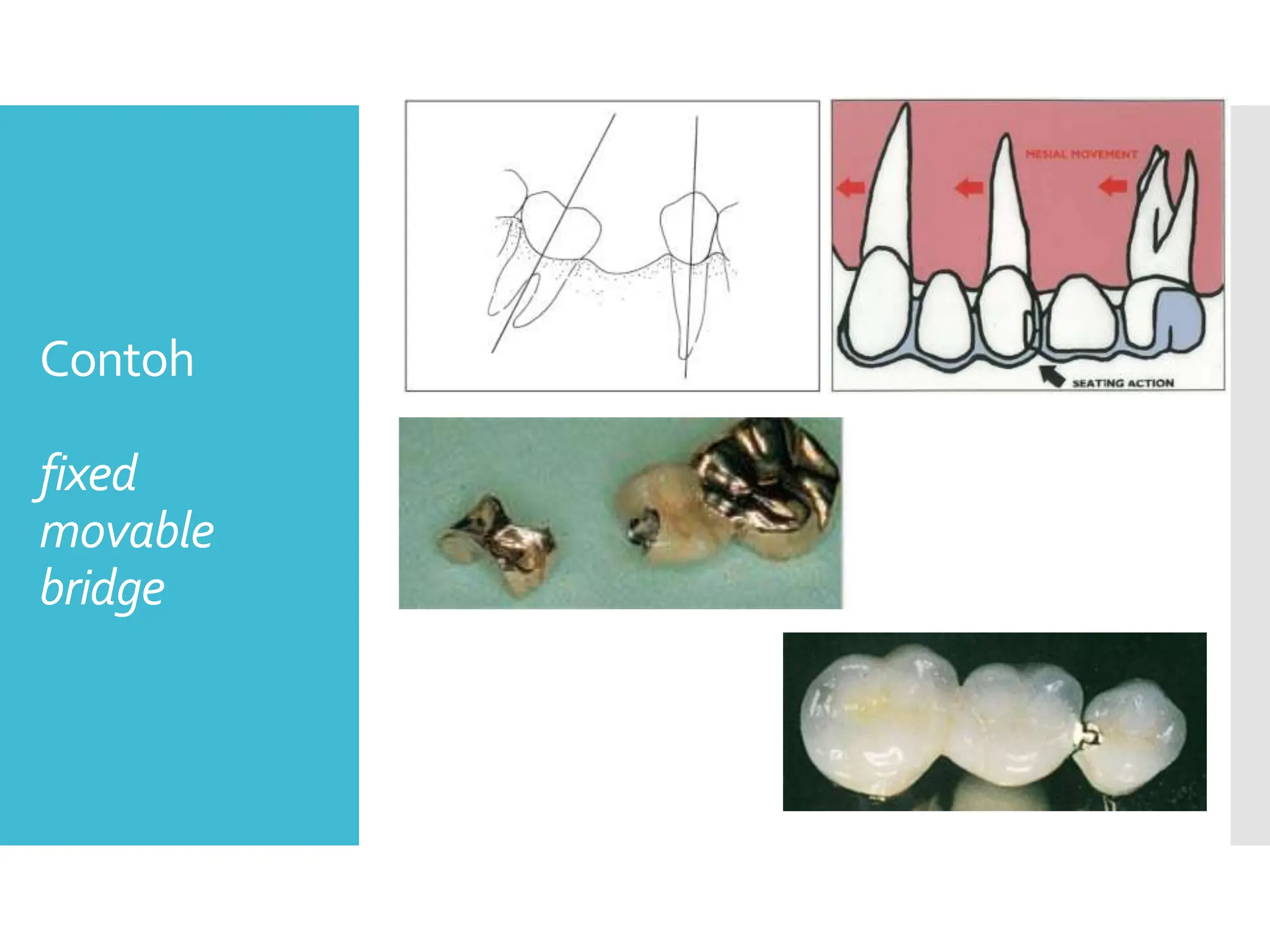 ilmu gigi tiruan fixed bridge / gigi tiruan jembatan | PPTX
