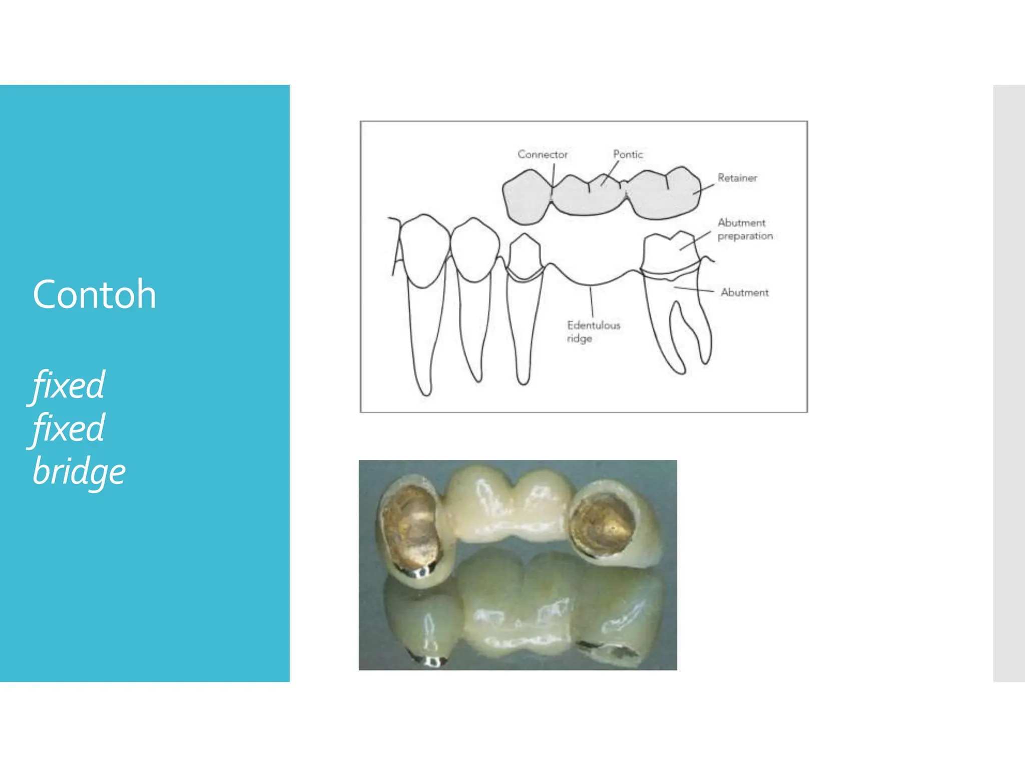 ilmu gigi tiruan fixed bridge / gigi tiruan jembatan | PPTX