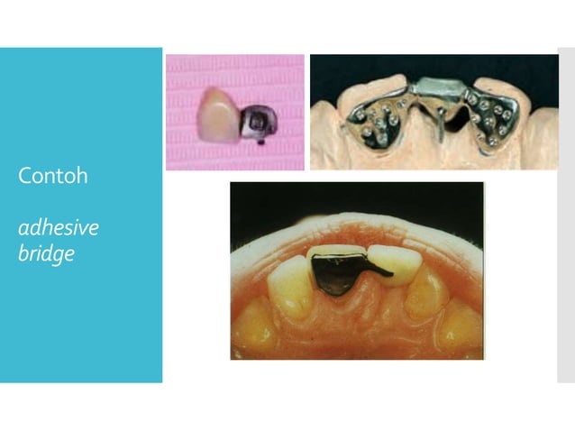 ilmu gigi tiruan fixed bridge / gigi tiruan jembatan | PPTX