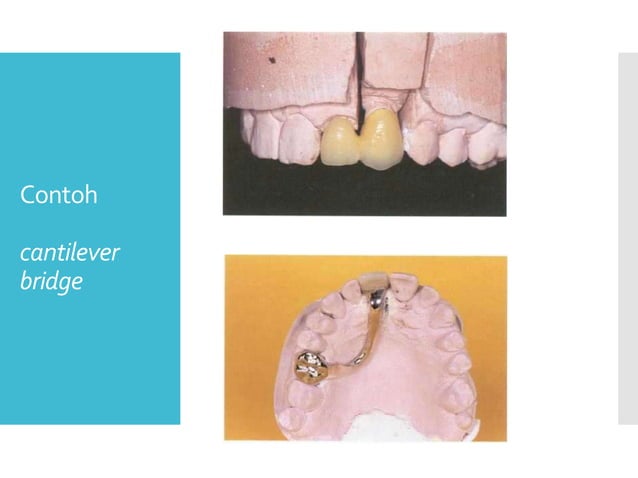ilmu gigi tiruan fixed bridge / gigi tiruan jembatan | PPTX