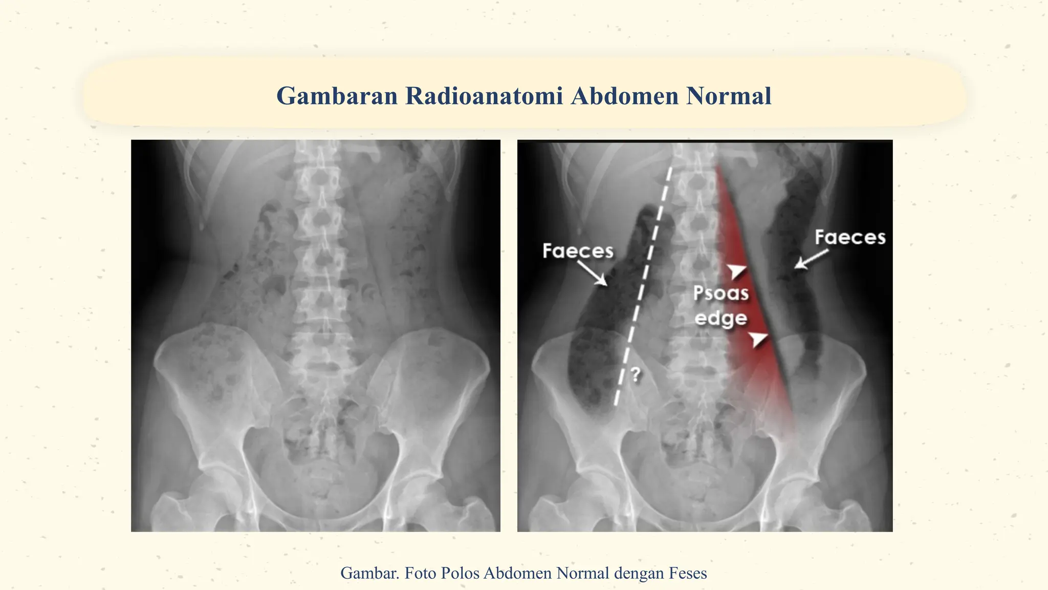 Power Point Ileus Paralitik Materi Pptx