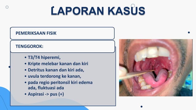 Diagnosis dan Tatalaksana Abses Peritonsilar | PPT