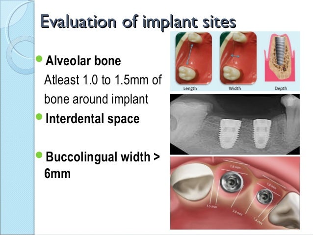 pretreatment Implant evaluation