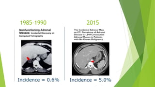 the adrenal incidentaloma | PPTX