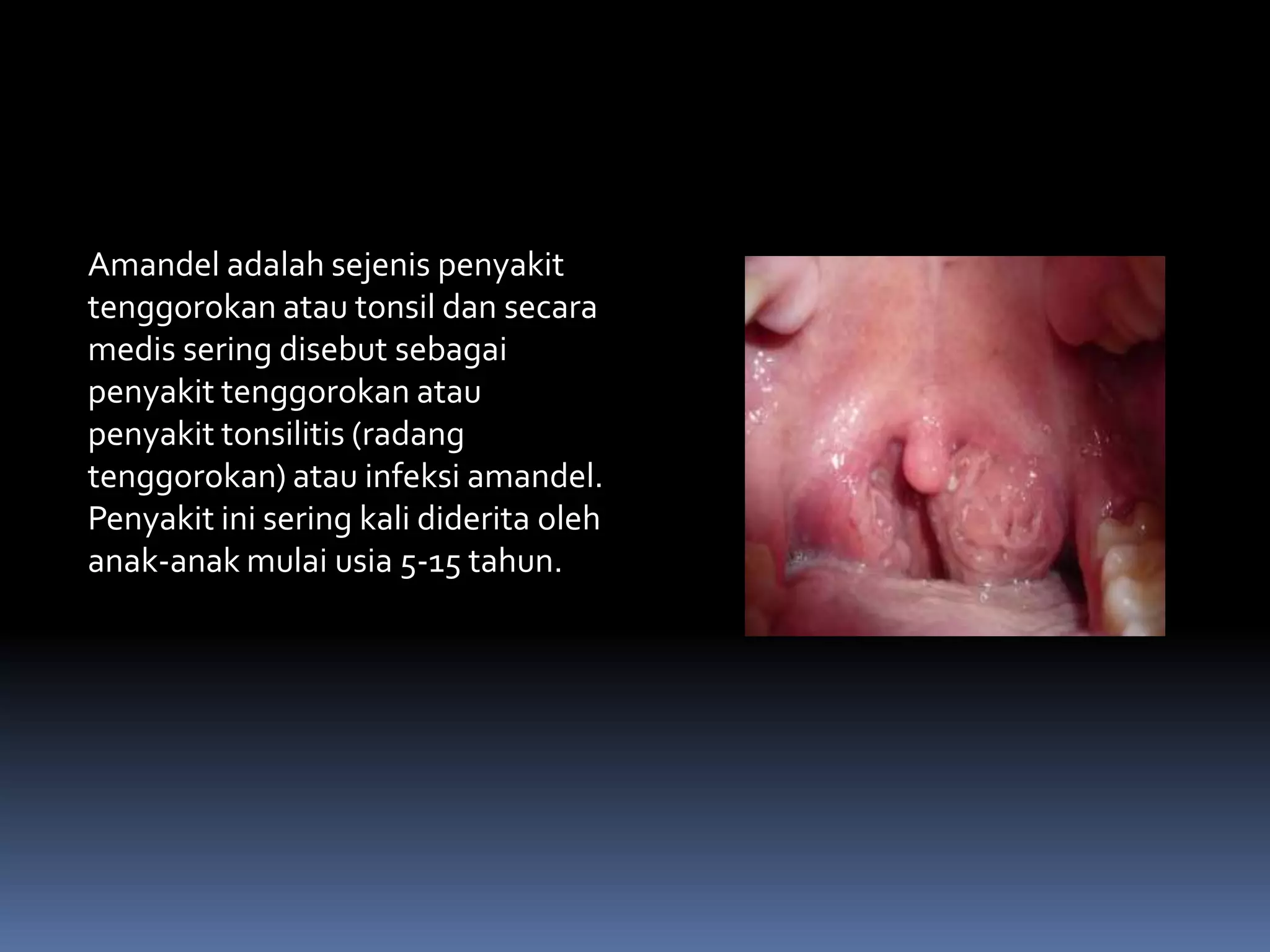 Infeksi Saluran Pernapasan Akut (ISPA) | PPTX