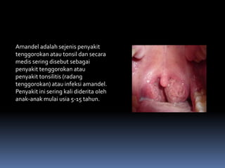 Infeksi Saluran Pernapasan Akut (ISPA) | PPTX