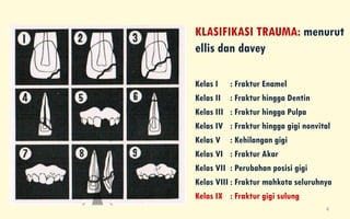 Delayed Treatment of Traumatized Primary Teeth with Distinct Pulp ...