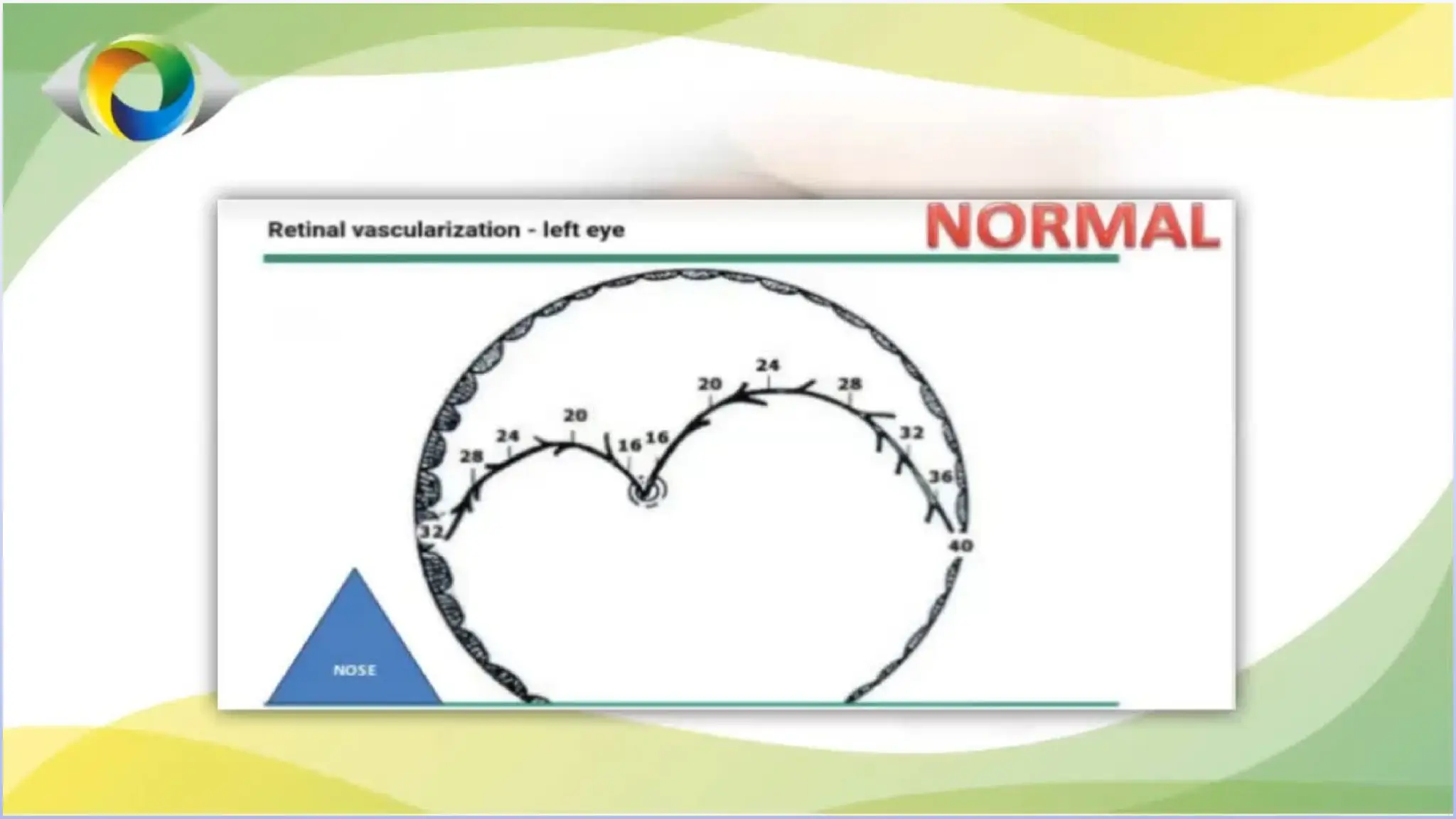 PPT Jurnal PO TG junral tentang retinopathy of prematurity, yaitu AP ROP, tindakan ...