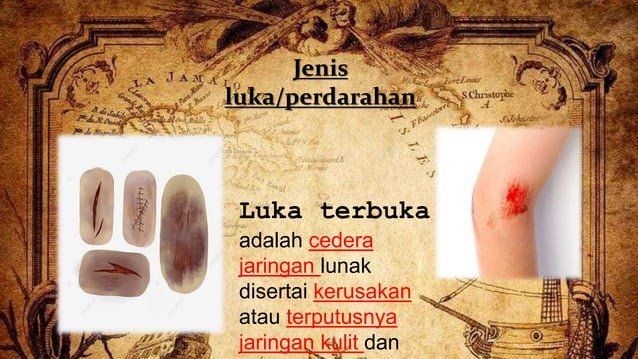 PPT PENGENDALIAN PADA LUKA TERBUKA DAN TERTUTUP.pptx