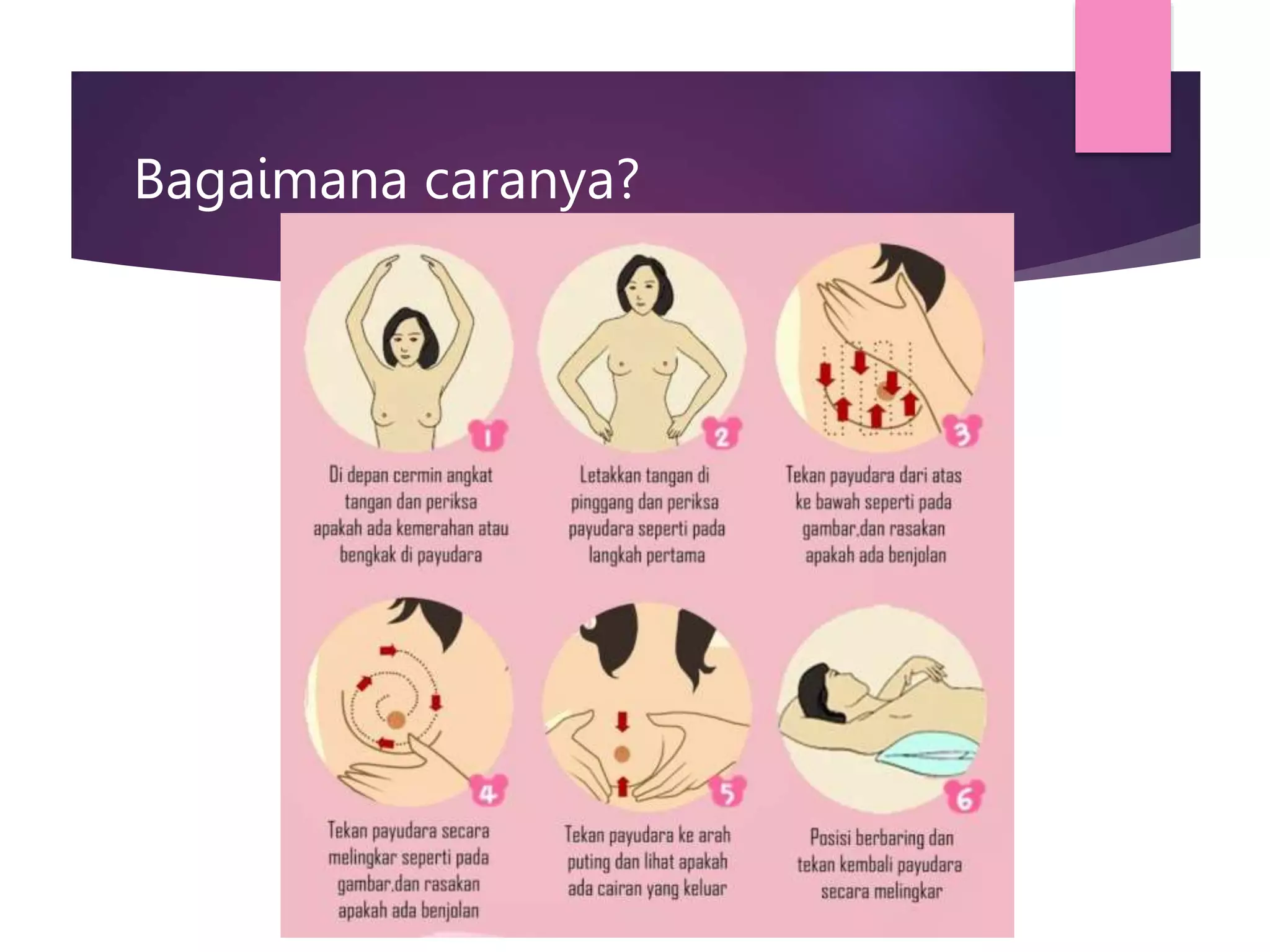 PPT KANKER PAYUDARA.pptx