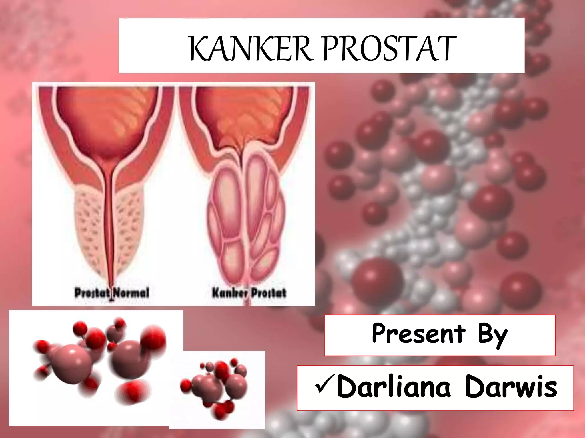 Ppt kanker prostat | PPTX