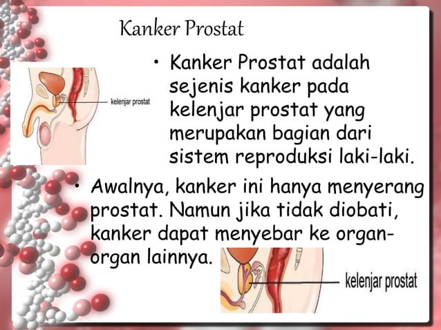Ppt kanker prostat | PPTX