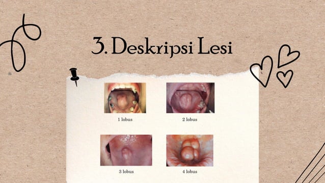 PPT KASUS 1 TORUS PALATINUS PENGERTIAN, JENIS.pptx