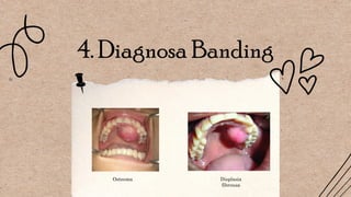 PPT KASUS 1 TORUS PALATINUS PENGERTIAN, JENIS.pptx