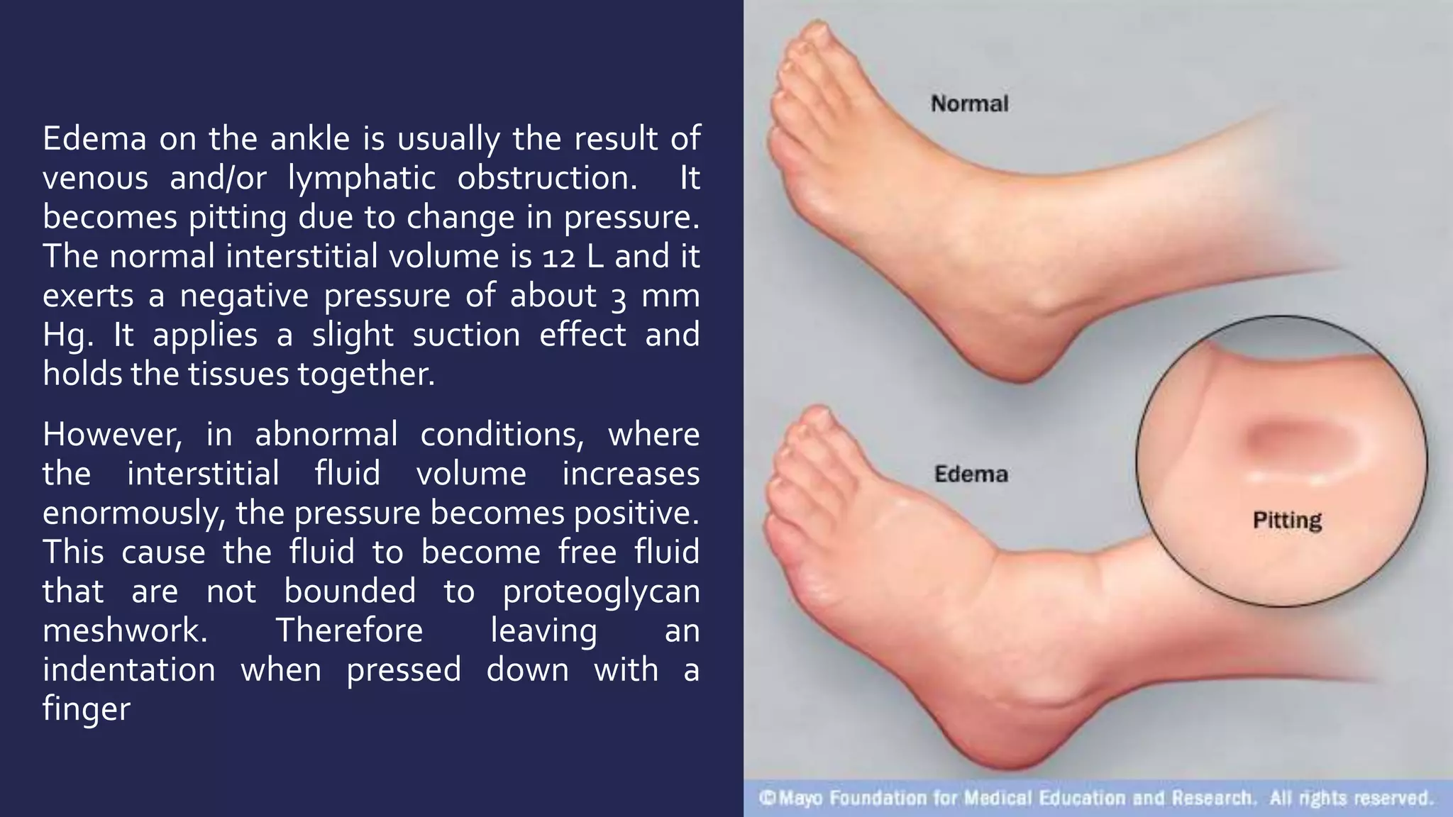 Ppt kelompok 15 kaki bengkak | PPTX