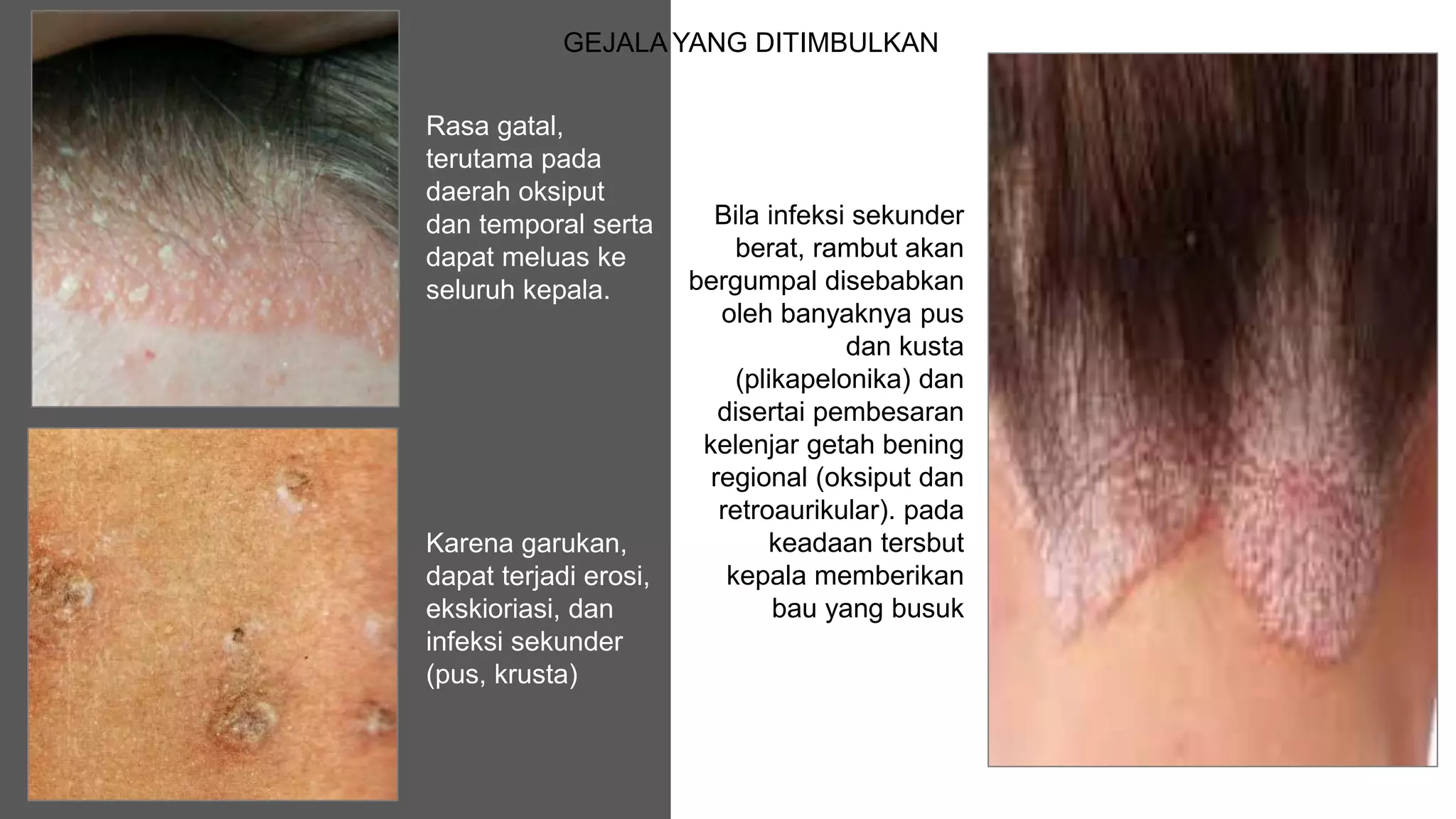 Morfologi kutu busuk, kutu rambut, kutu kemaluan | PPTX