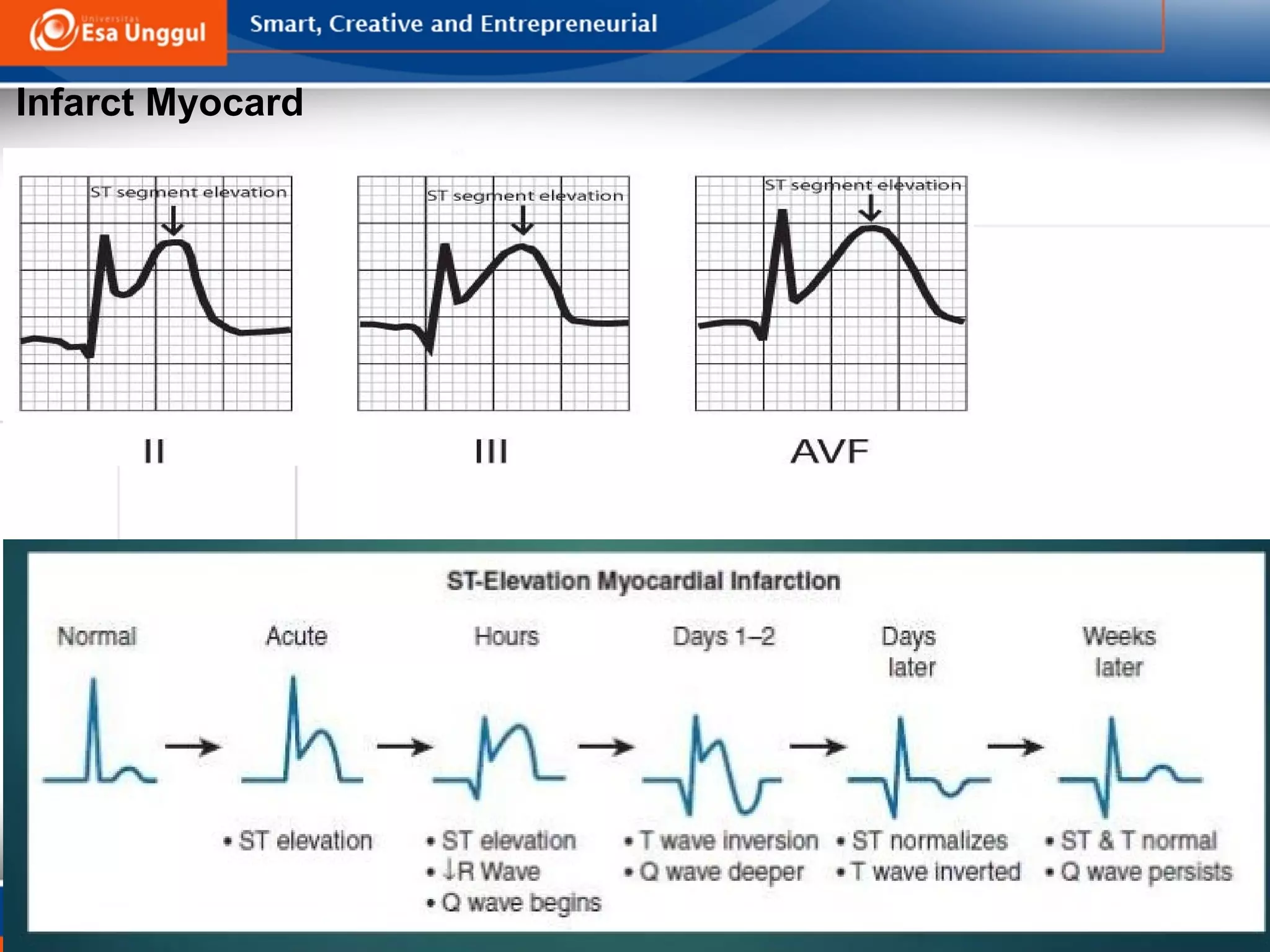 Acute Coronary Syndome | PPT