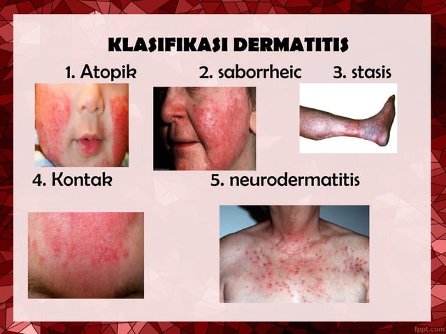 Dermatitis | PPT