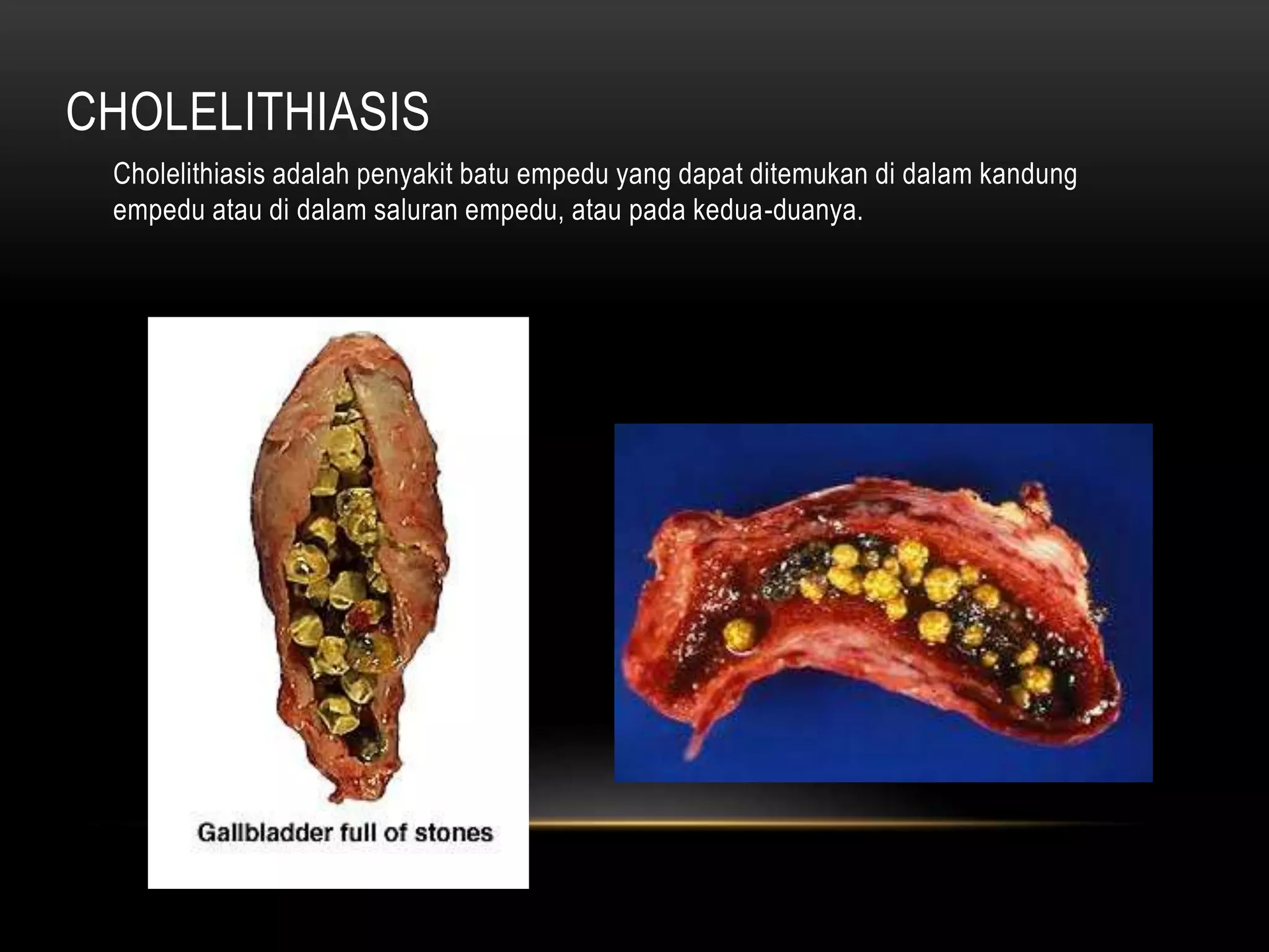 PPT KOLELITIASIS.ppt