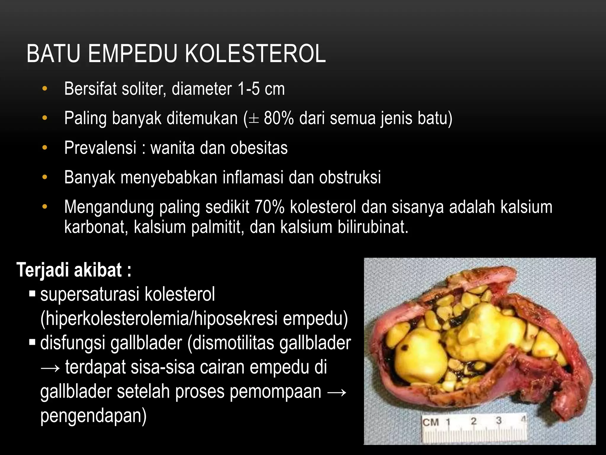 PPT KOLELITIASIS.ppt