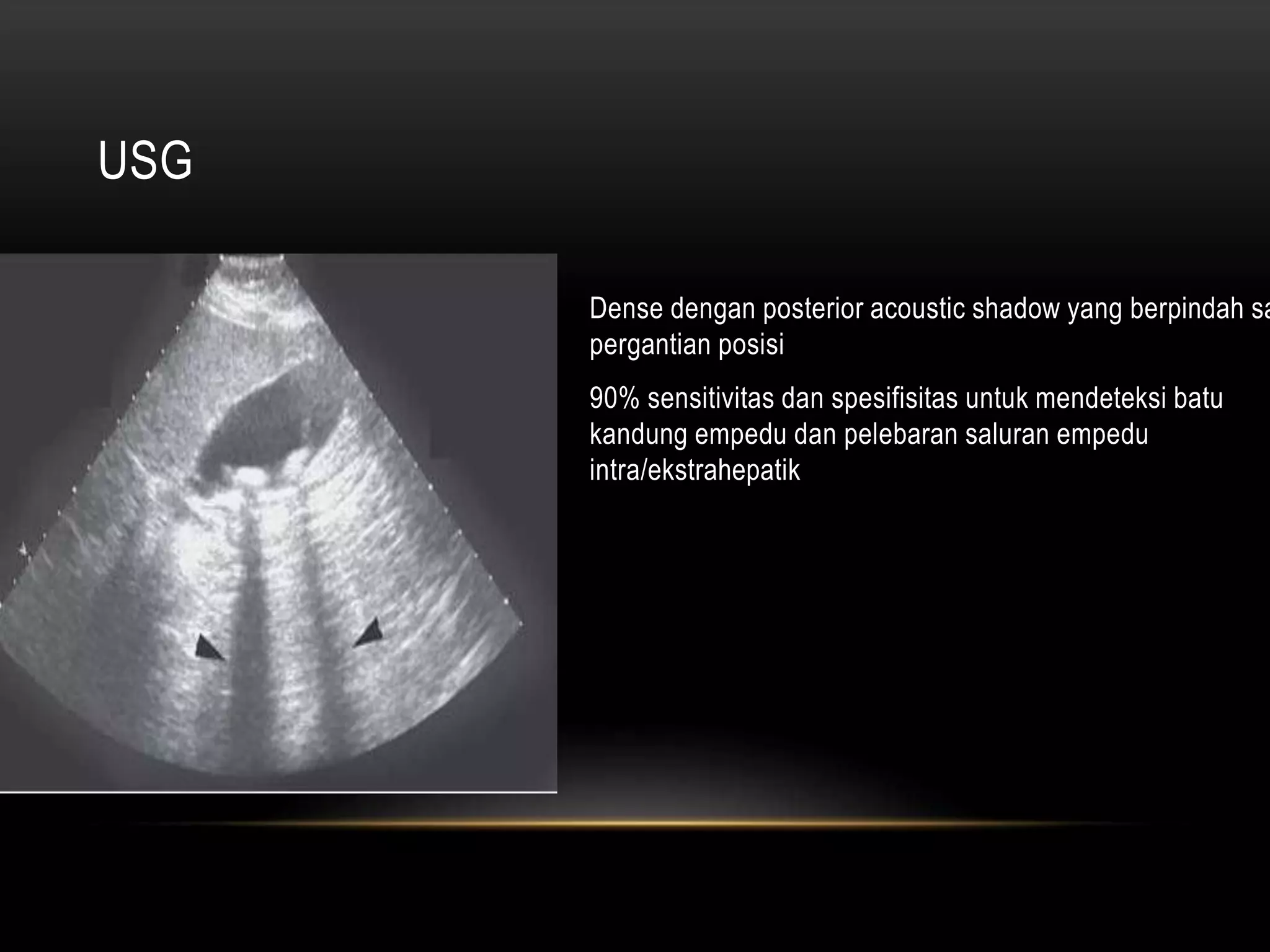 PPT KOLELITIASIS.ppt