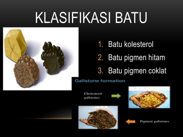 PPT KOLELITIASIS.ppt