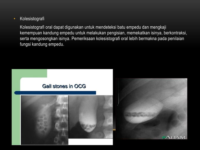PPT KOLELITIASIS.ppt