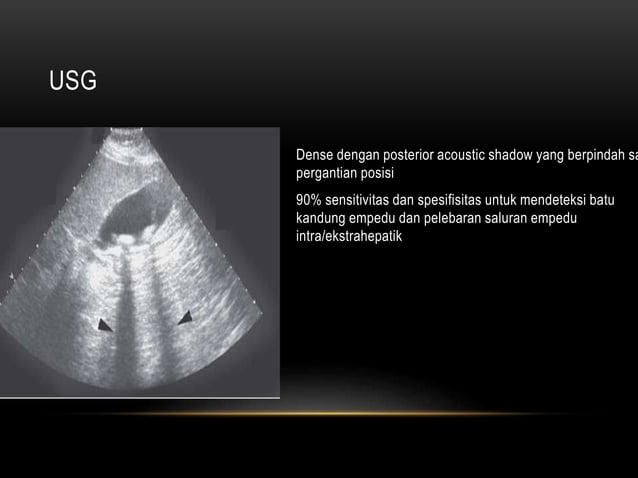 PPT KOLELITIASIS.ppt