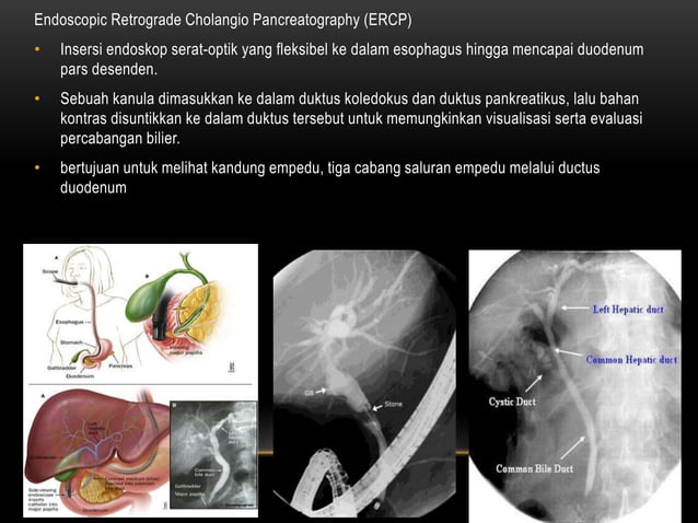 PPT KOLELITIASIS.ppt
