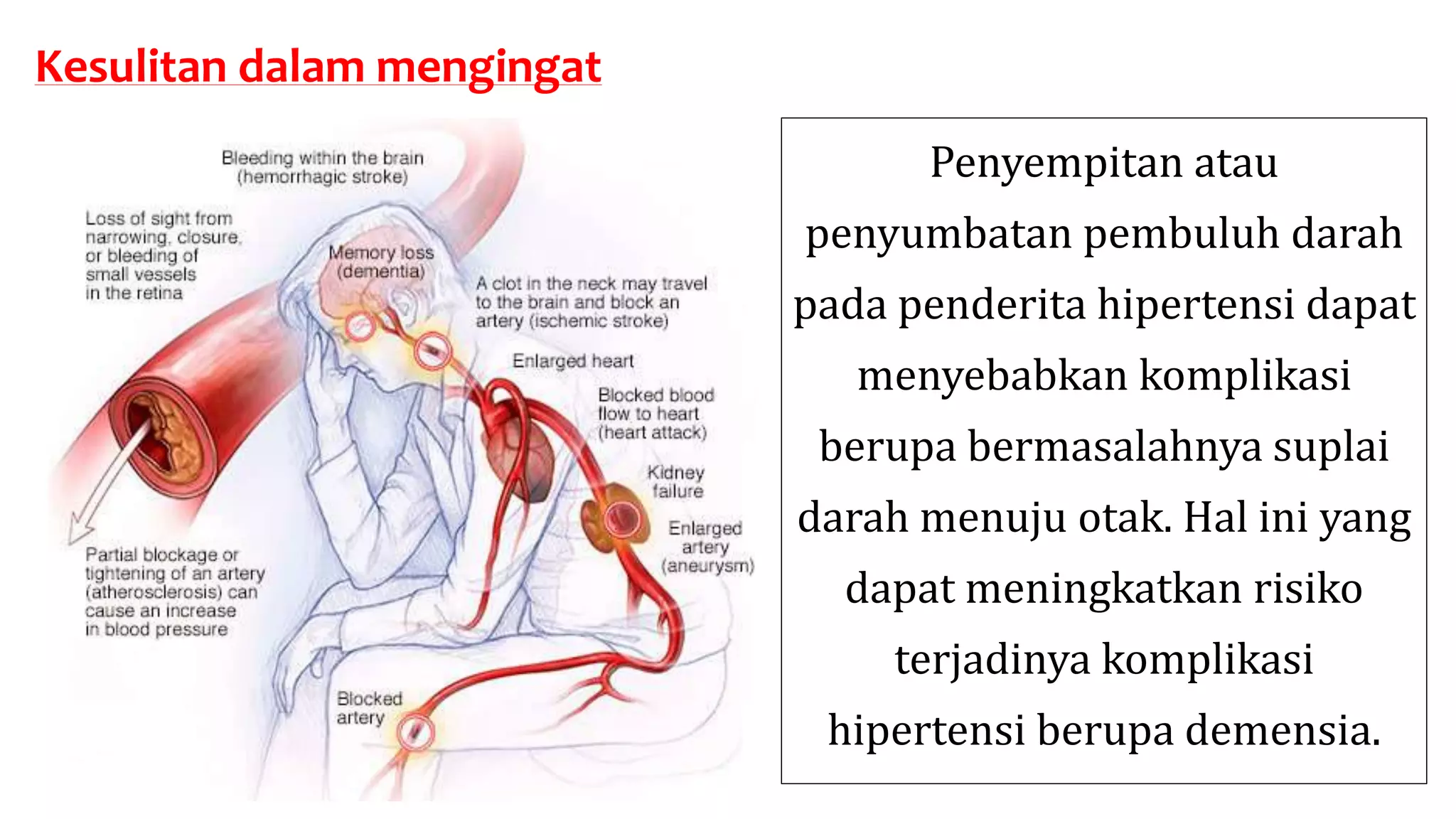 PPT KOMPLIKASI HIPERTENSI.pptx