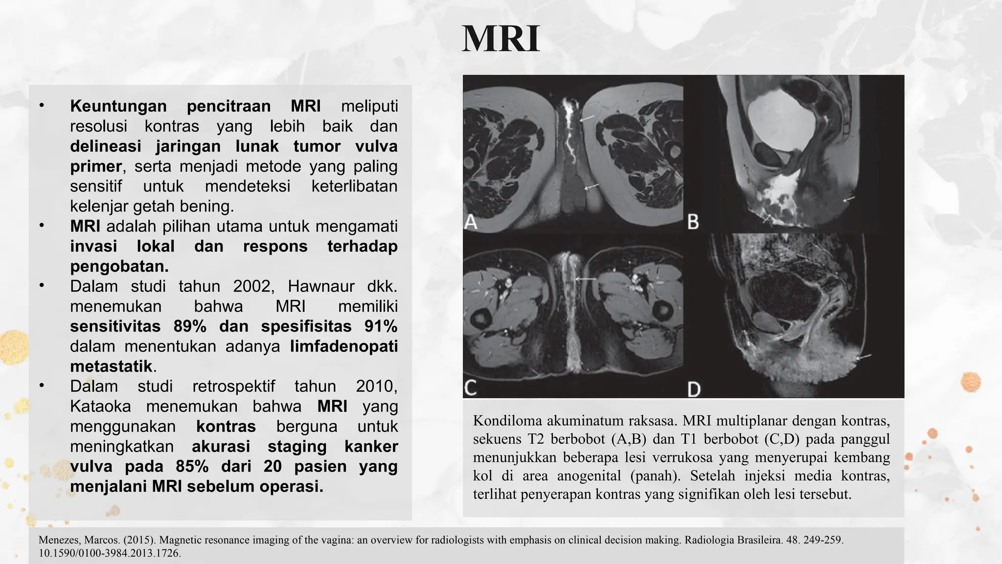 PPT Kondiloma Akuminata - Radioterapi.pptx