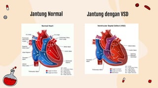 PPT PENYAKIT JANTUNG BAWAAN PADA ANAK.pptx