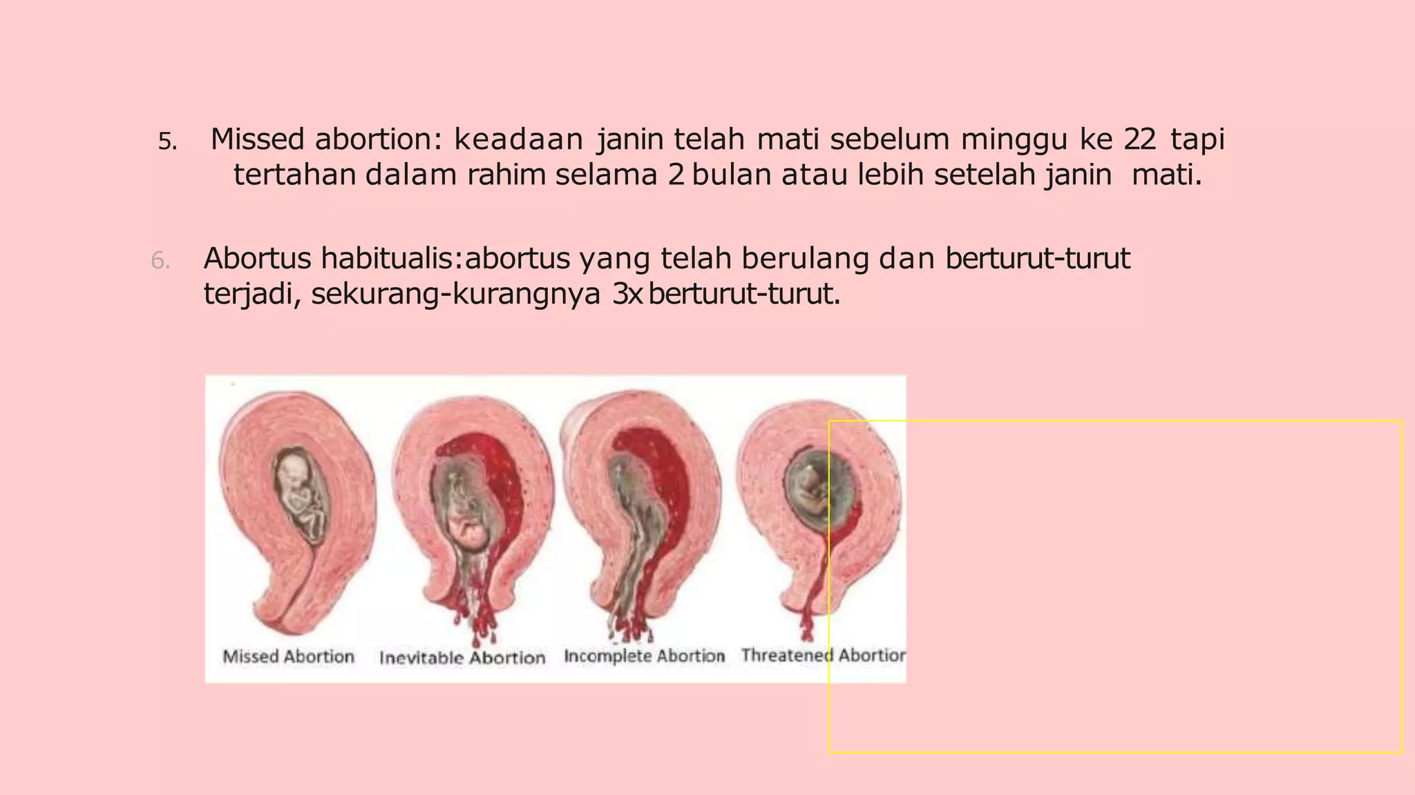 ppt lapkas abortus (1).pptx