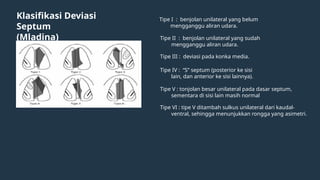 PPT LAPKAS DEVIASI SEPTUM deviasi powerpoint | PPTX