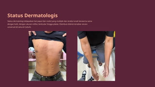 PPT Lapkas Kulit Neurofibromatosis tipe I | PPTX