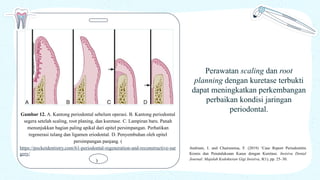 PPT LAPKAS KURETASE GINGIVA blbjkuj.pptx