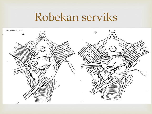 ppt laserasi jalan lahir keperawatan maternitas | PPTX