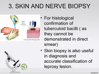 Mycobacterium leprae - Lab diagnosis | PPT